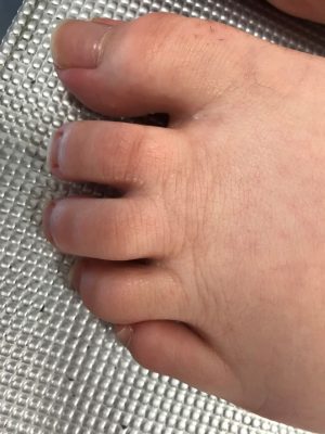 Les Lymphœdèmes - AVML - Association Vivre Mieux le Lymphœdème